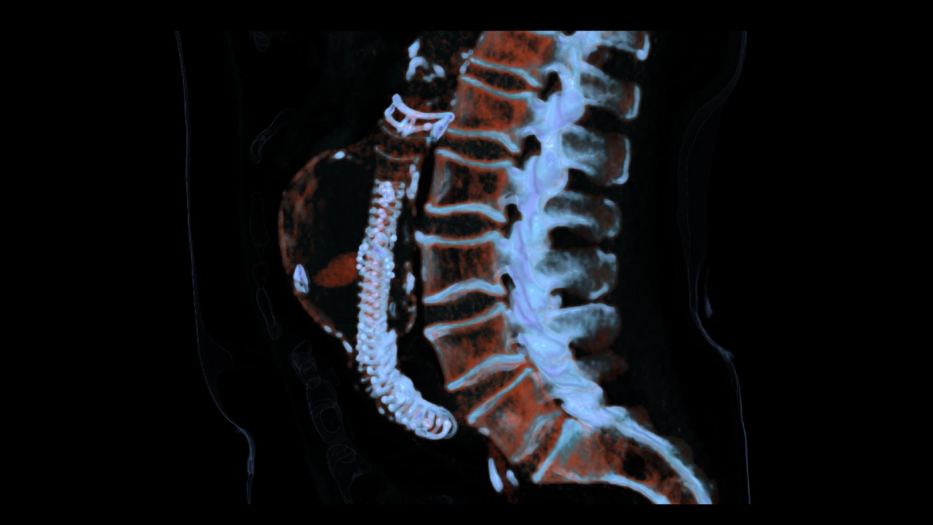 Discovery Of A Type Ii Endoleak After Evar Using Dynamic 4d Ct