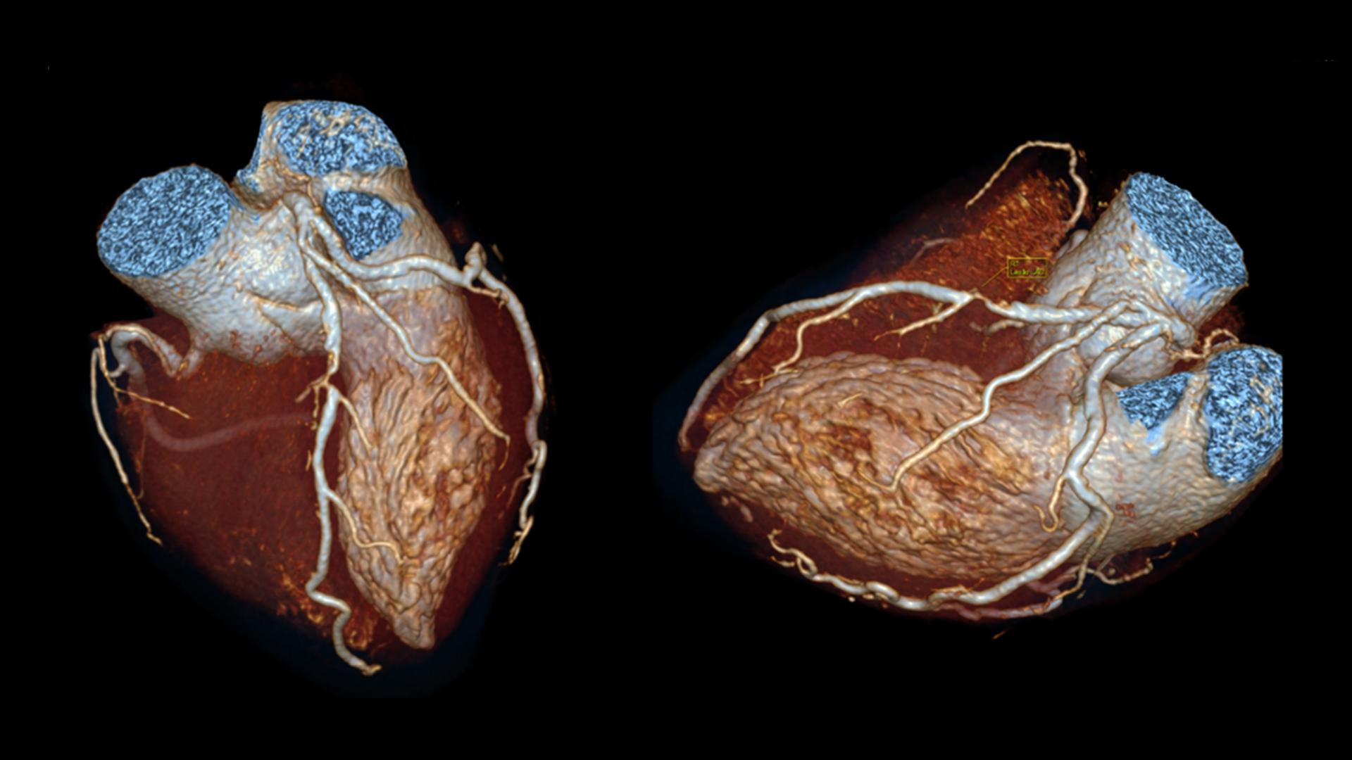 Low Dose Coronary CT Angiography using ECG-Gated Retrospective Spiral CT