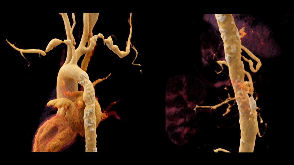 Extensive Takayasu Arteritis - Siemens Healthineers USA