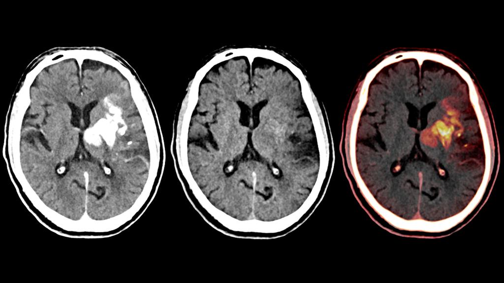 Intracranial Hyperdense Lesion after Intra-arterial Recanalization ...