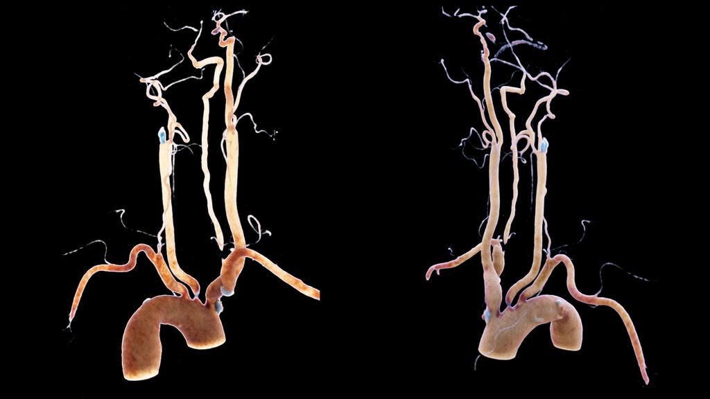 Complete Occlusion of the Left Internal Carotid Artery - Siemens ...