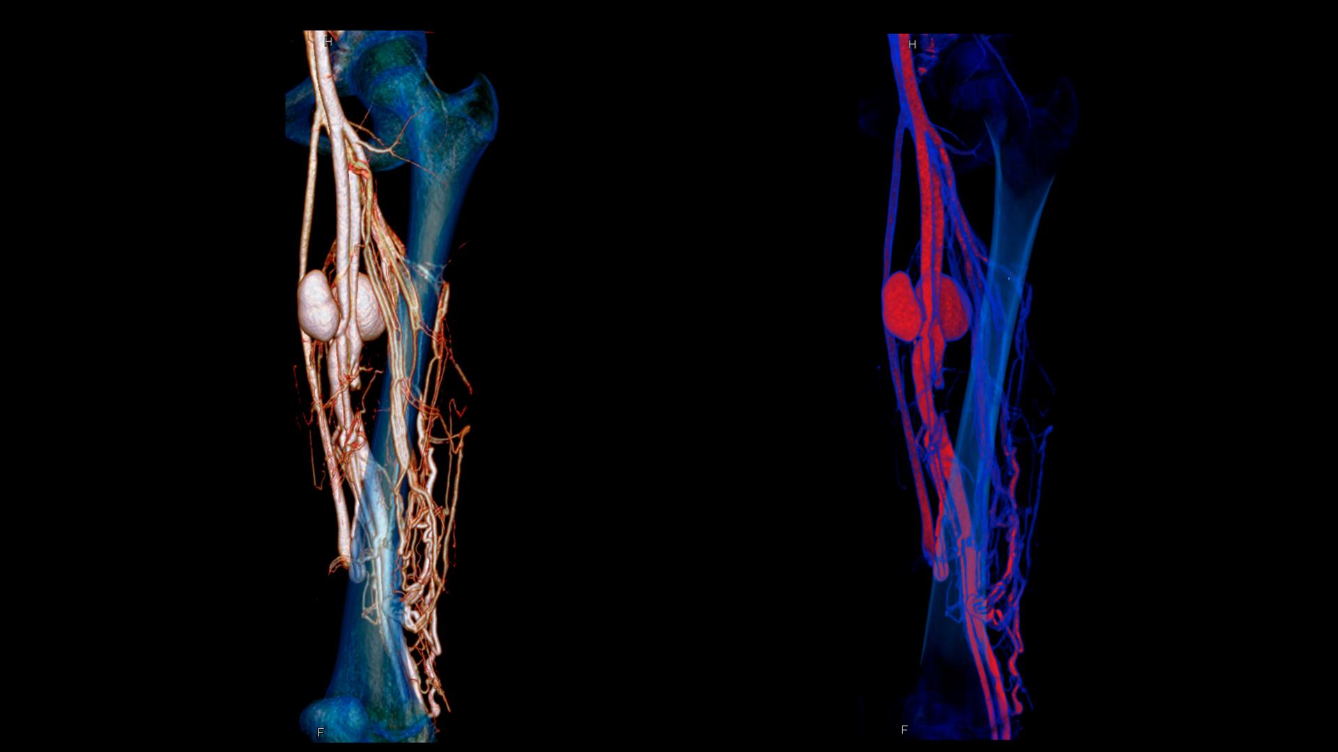 Evaluation of Femoral Artery Pseudoaneurysms with Arteriovenous Fistula ...