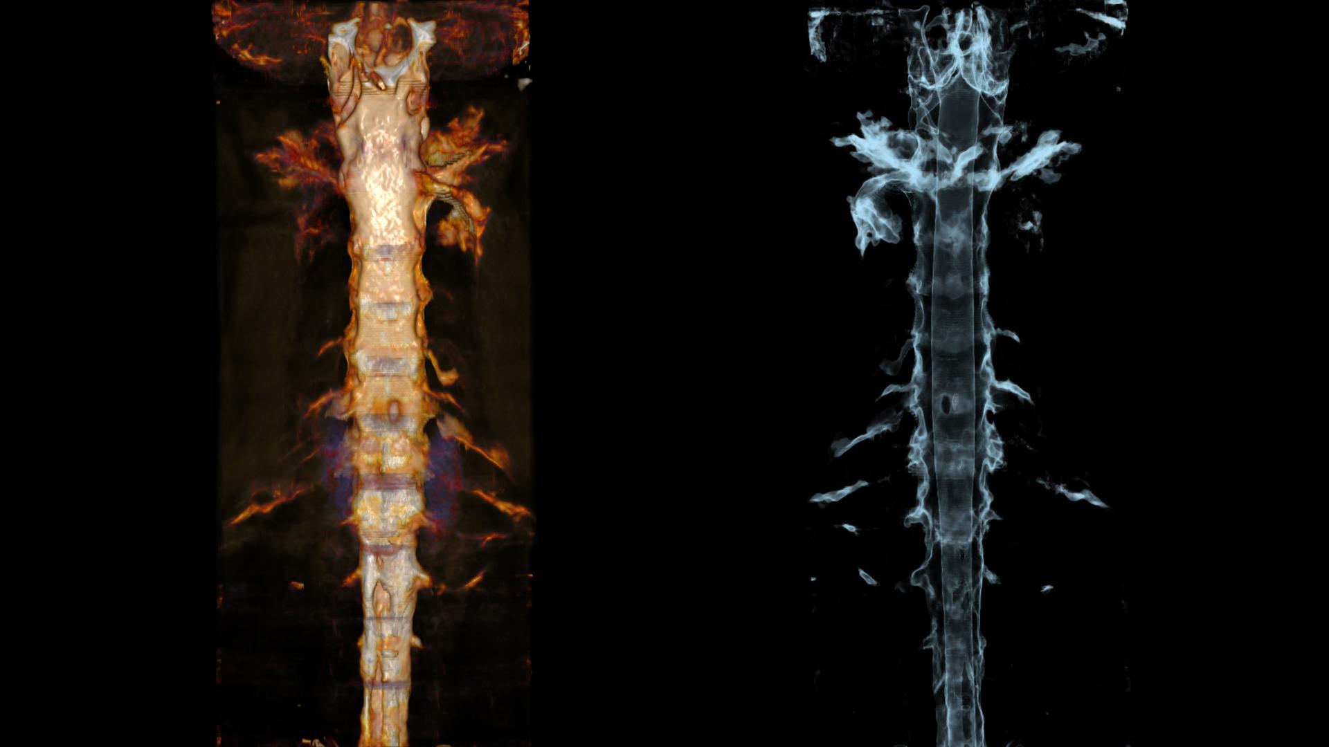 Dual Energy CT Myelography Used to Detect Spontaneous Spinal ...