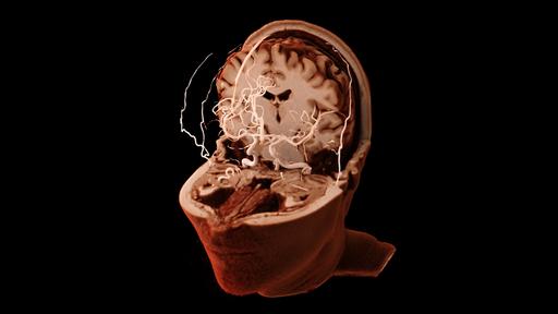 Compressed Sensing - Siemens Healthineers