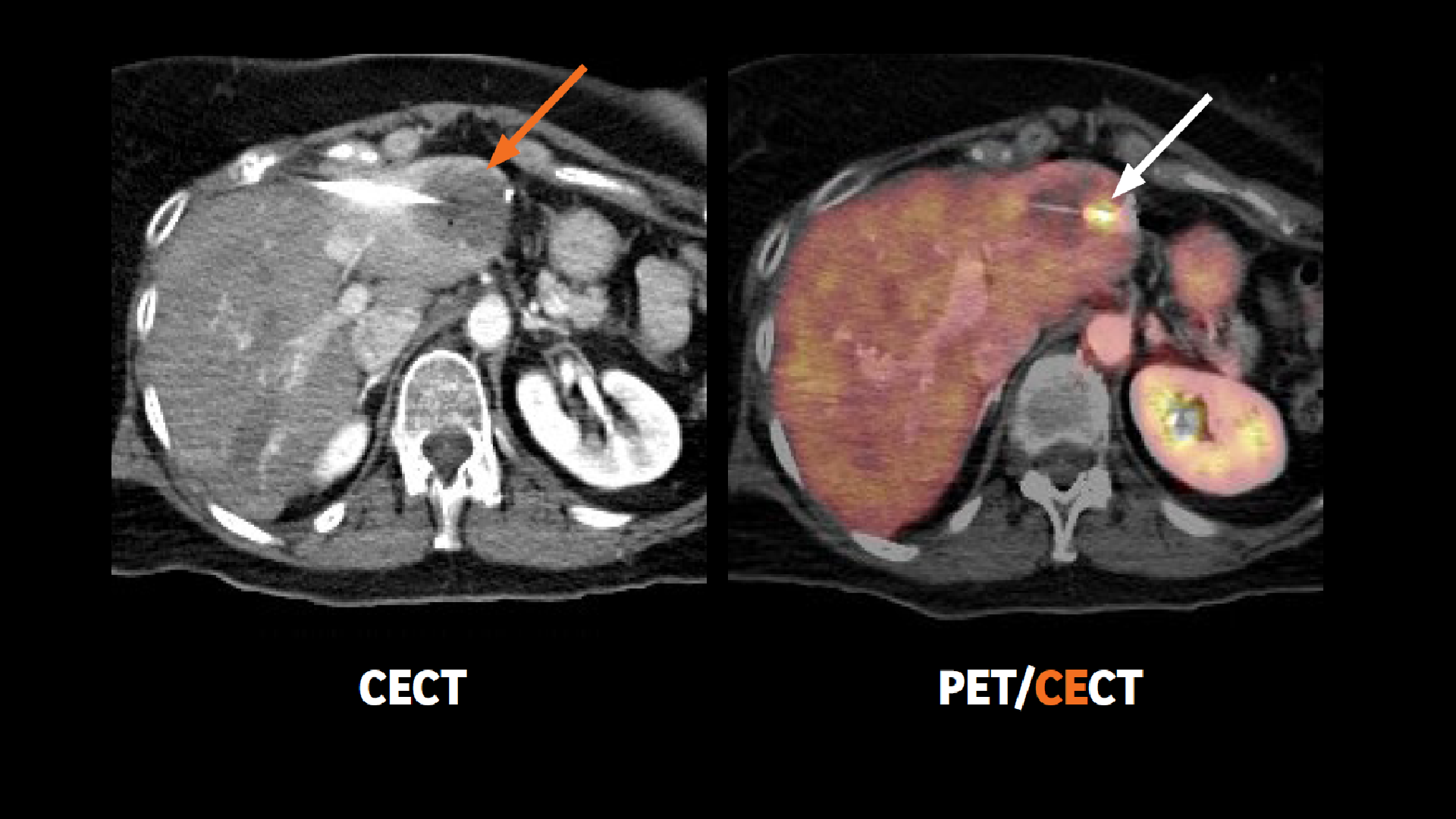 Dual injection PET/CT-guided intervention for ablation of liver ...