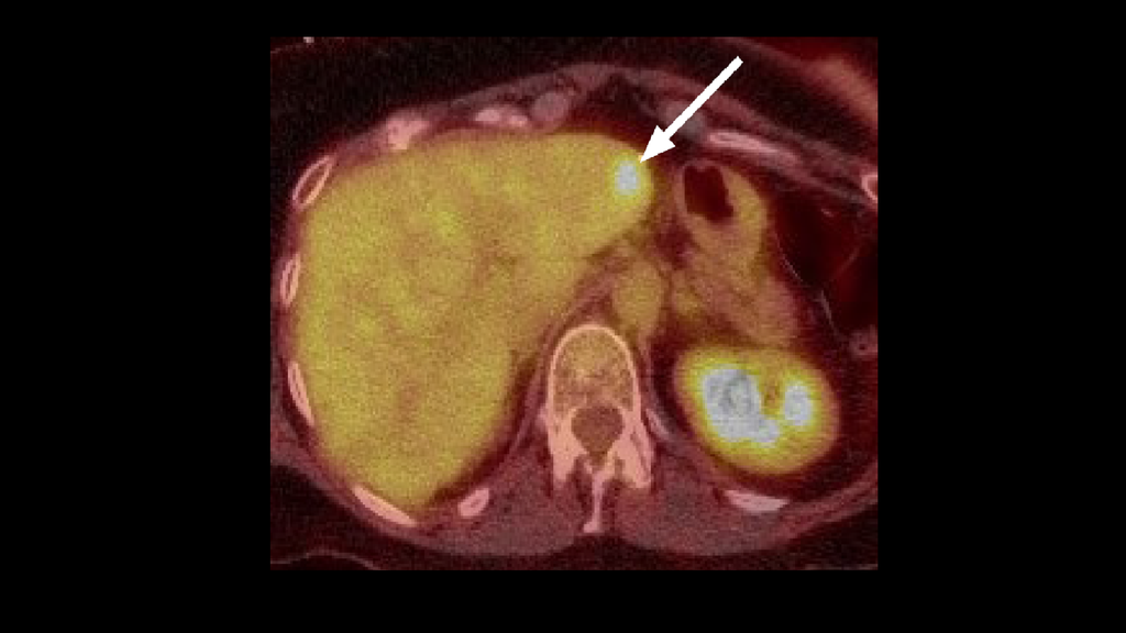 Dual injection PET/CT-guided intervention for ablation of liver ...