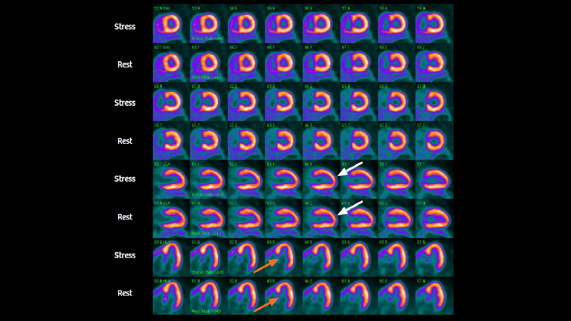 Co-existing coronary artery disease in a patient with hypertrophic ...