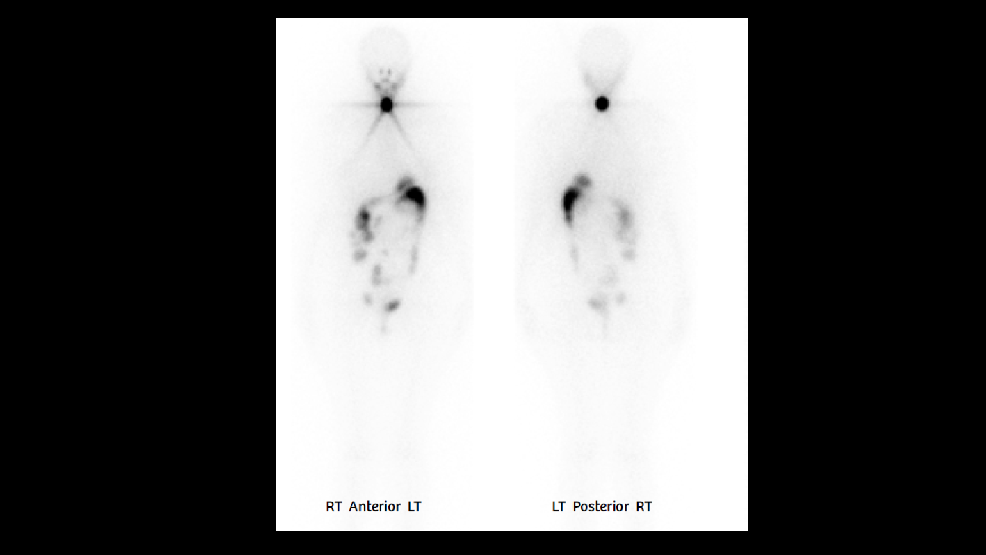 PET/CT detection of Fludeoxyglucose F 18 Injection (18F FDG)-avid ...