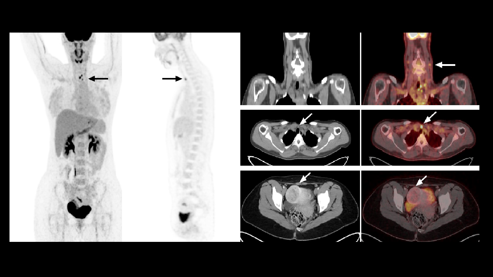 PET/CT detection of Fludeoxyglucose F 18 Injection (18F FDG)-avid ...