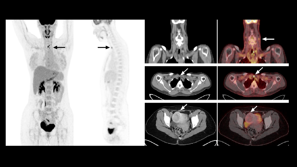 PET/CT detection of Fludeoxyglucose F 18 Injection (18F FDG)-avid ...