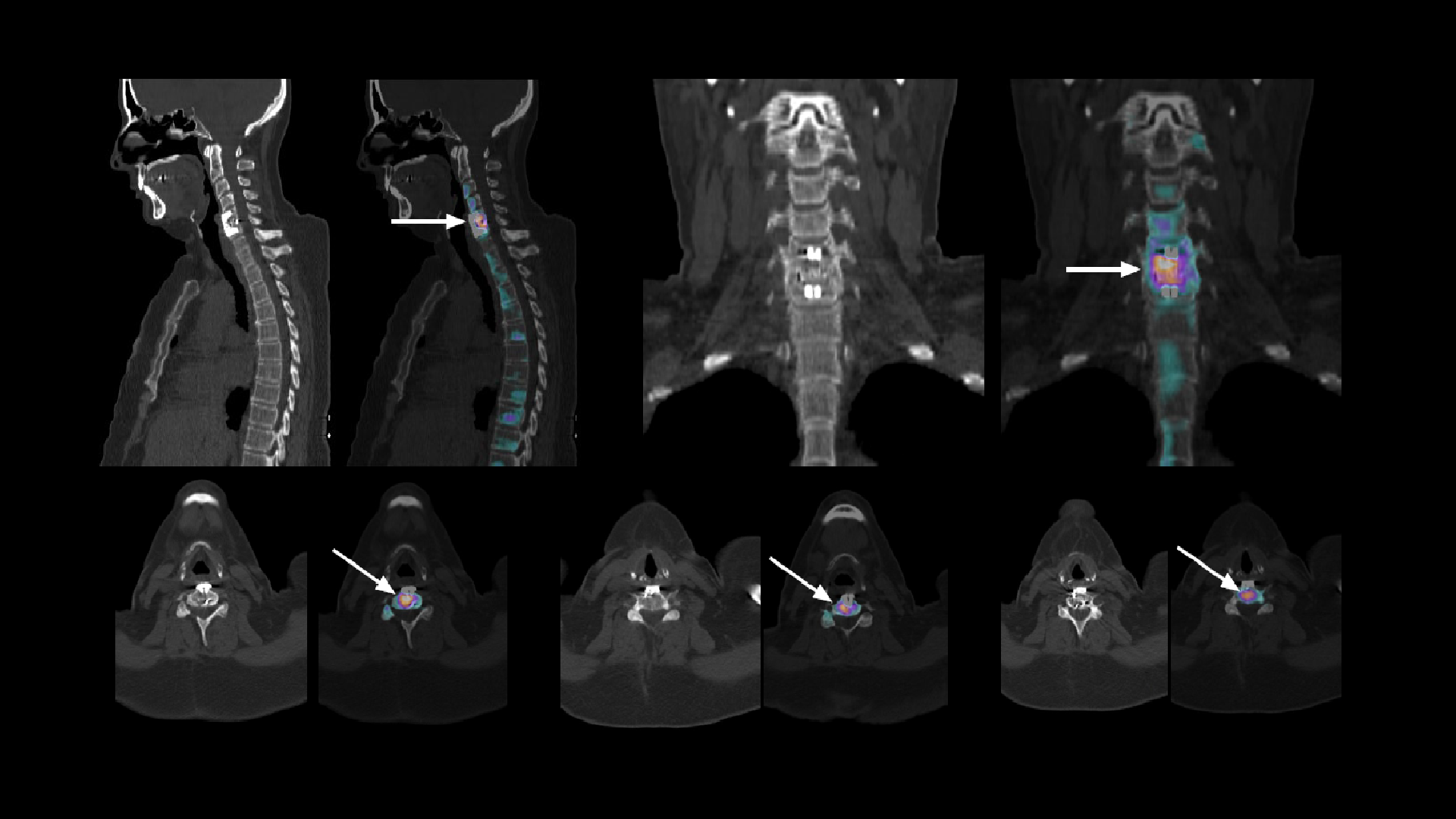xSPECT Bone used to delineate cervical vertebral screw loosening ...