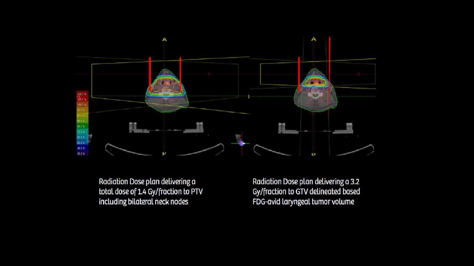 Coexisting laryngeal tumor in a patient with esophageal carcinoma ...