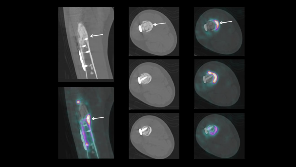 SPECT/CT delineation of proximal screw loosening and distal ...