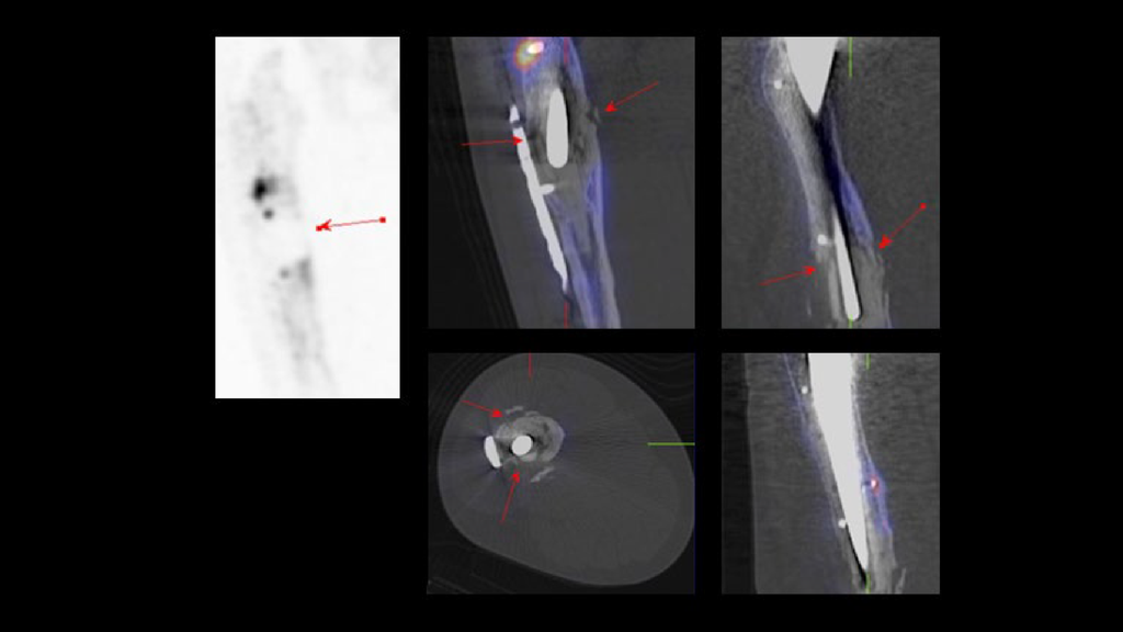 SPECT/CT delineation of proximal screw loosening and distal ...