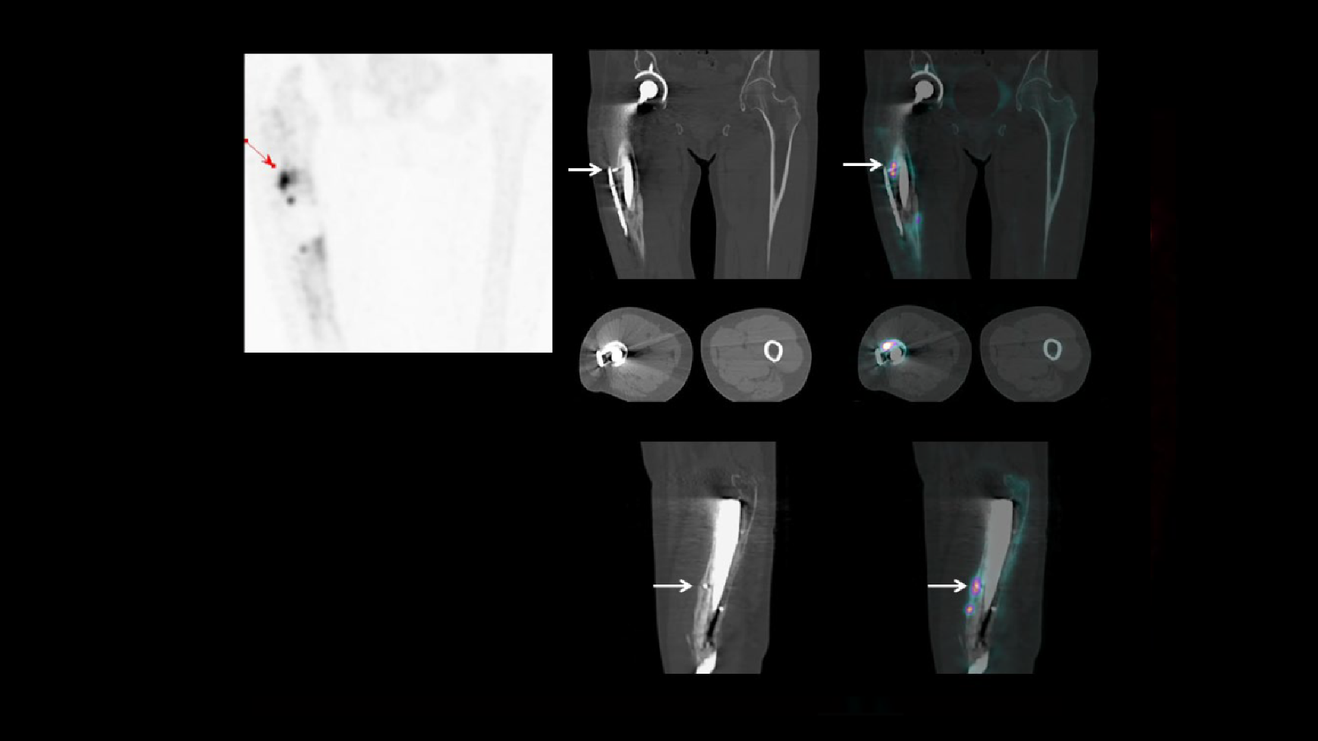 SPECT/CT delineation of proximal screw loosening and distal ...