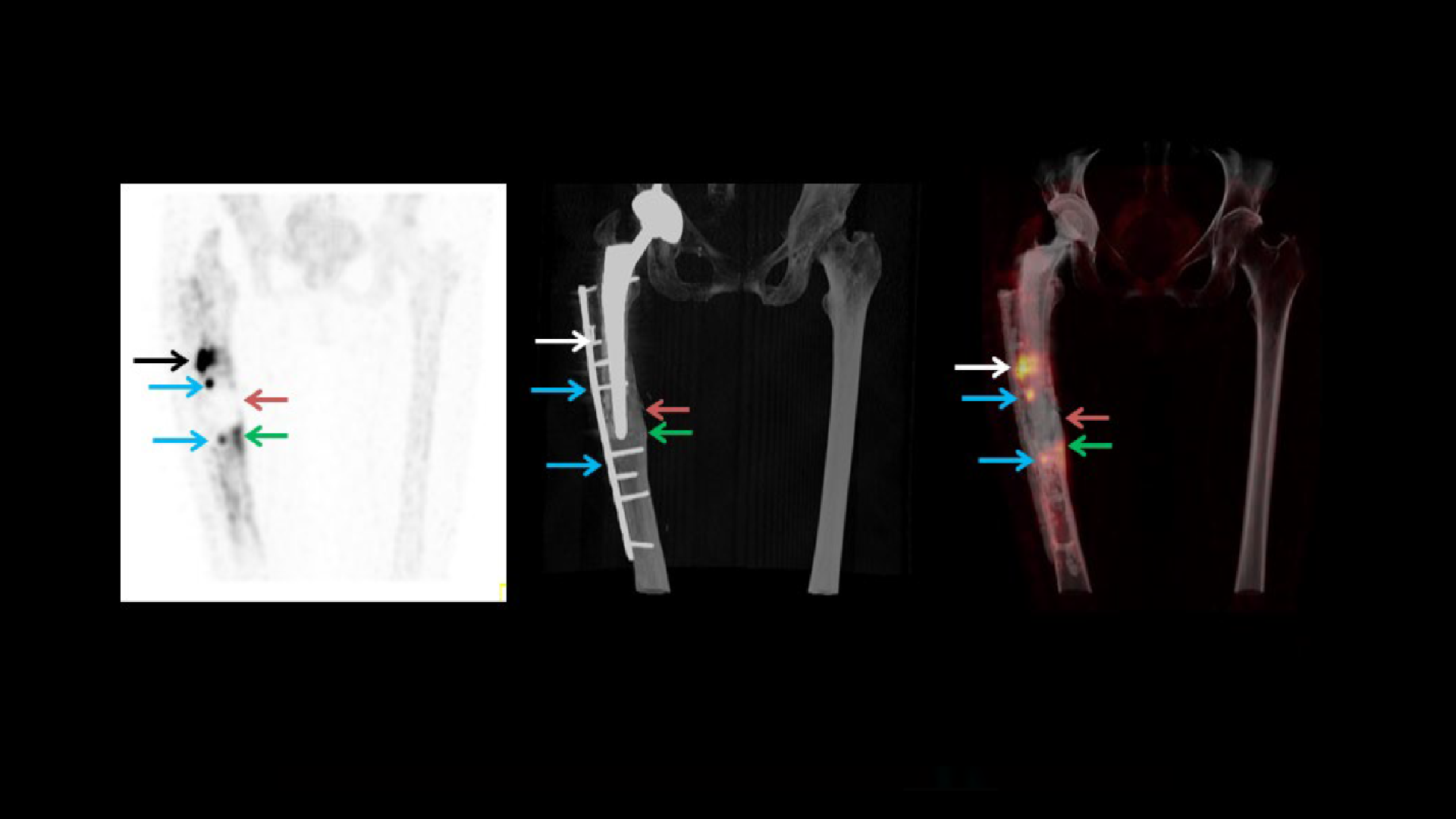 SPECT/CT delineation of proximal screw loosening and distal ...