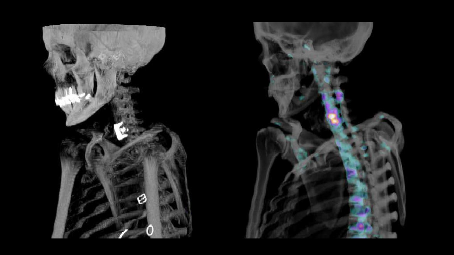 xSPECT Bone used to delineate cervical vertebral screw loosening ...