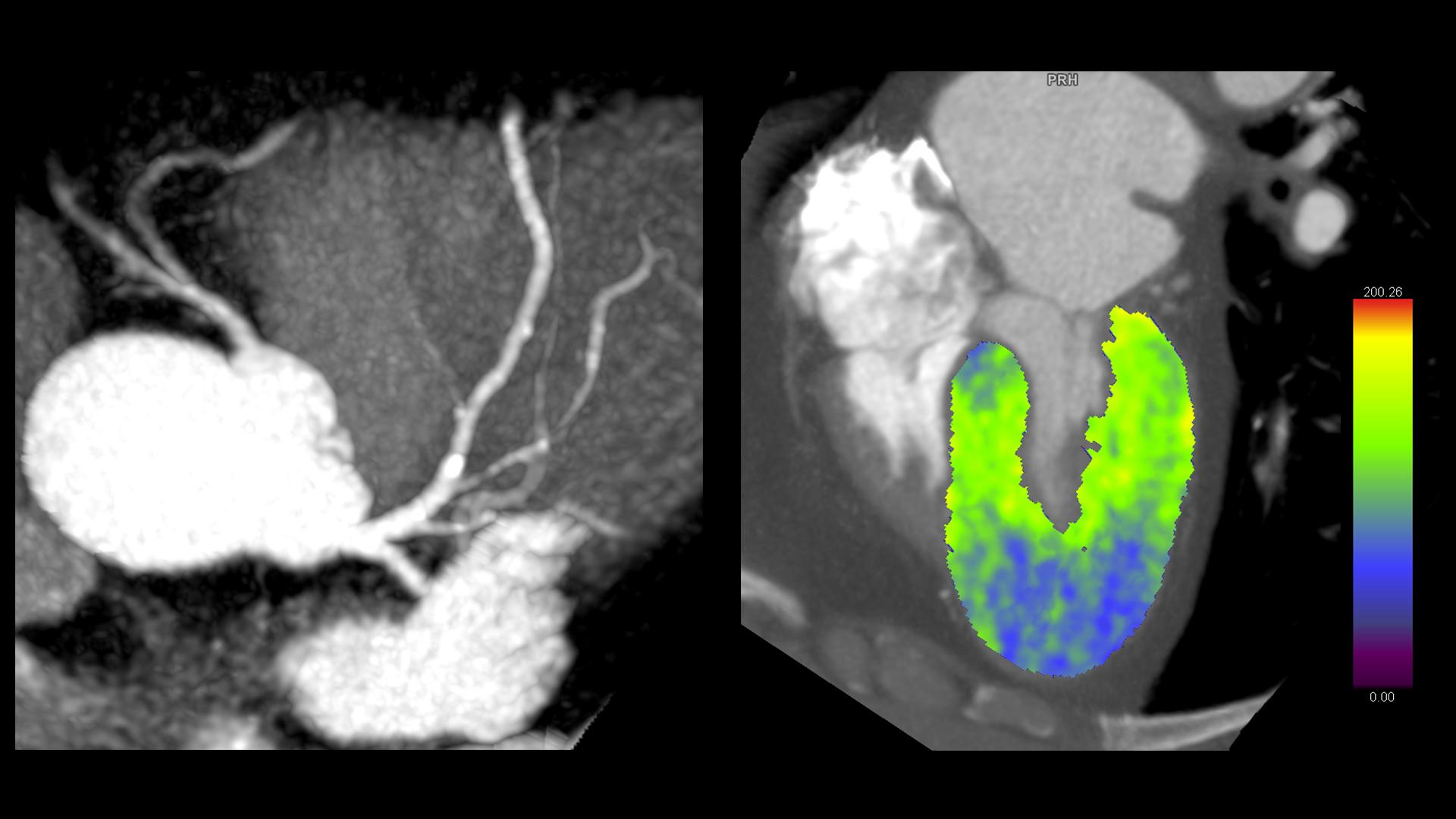 Apical Hypertrophic Cardiomyopathy - Siemens Healthineers USA