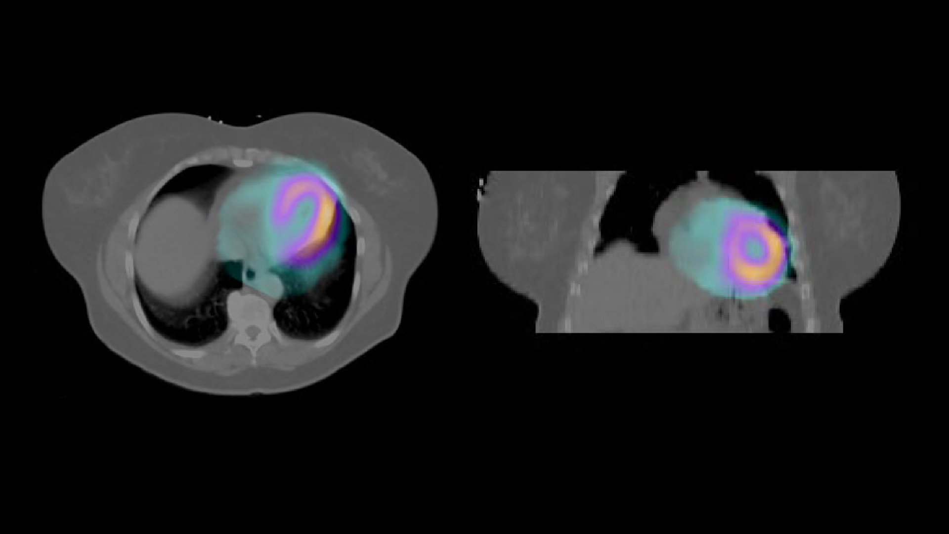 SPECT/CT overcomes breast-attenuation artifact for improved specificity ...