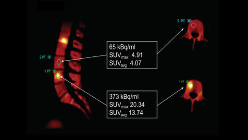 Accurate, Reproducible, And Standardized Quantification - Siemens ...