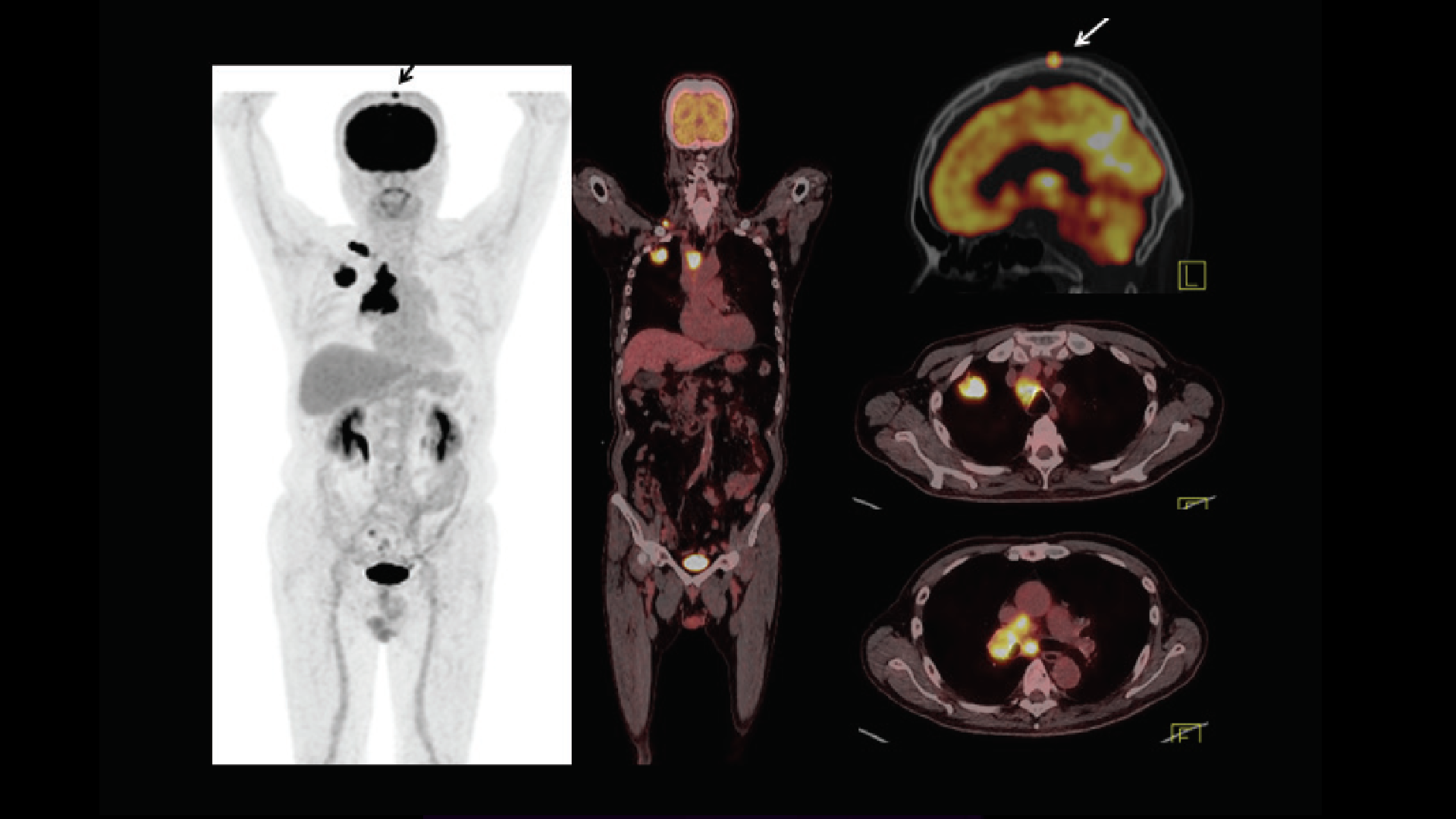 Current role of PET/CT in evaluation of lung cancer - Siemens ...