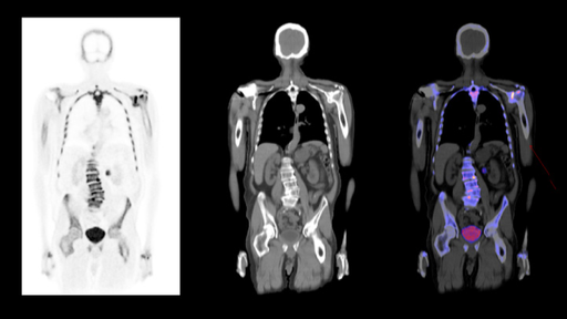 NaF PET/CT in prostate cancer - Siemens Healthineers Bulgaria