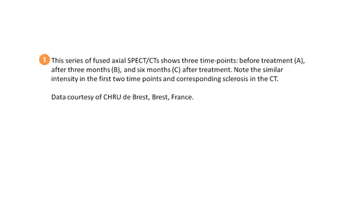 xSPECT Quant in treatment monitoring - Siemens Healthineers