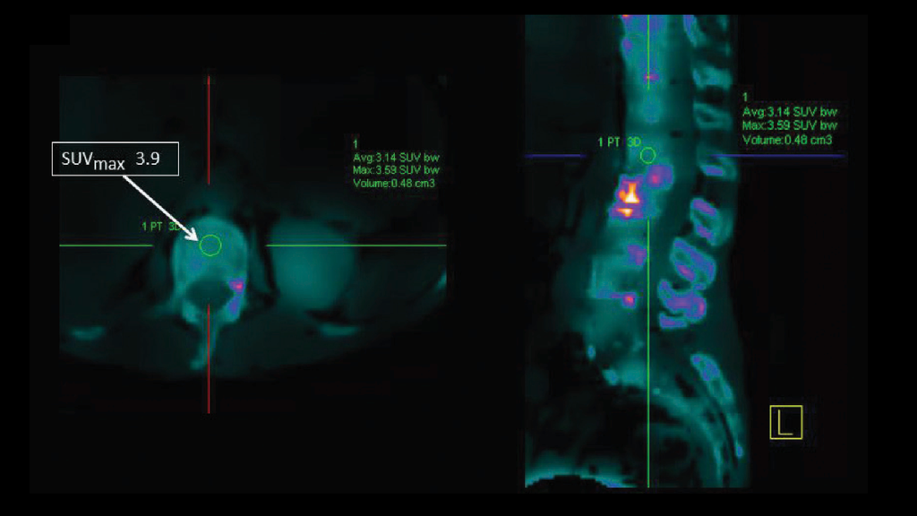 Partial vertebral compression defined by xSPECT Bone - Siemens ...