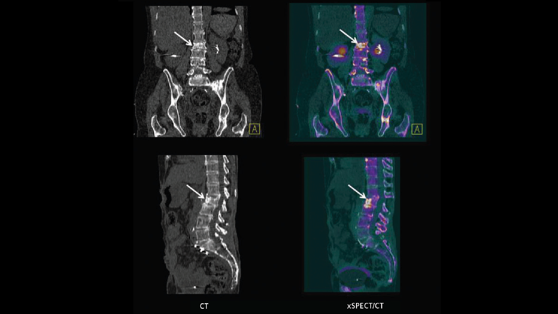 Partial vertebral compression defined by xSPECT Bone - Siemens Healthineers