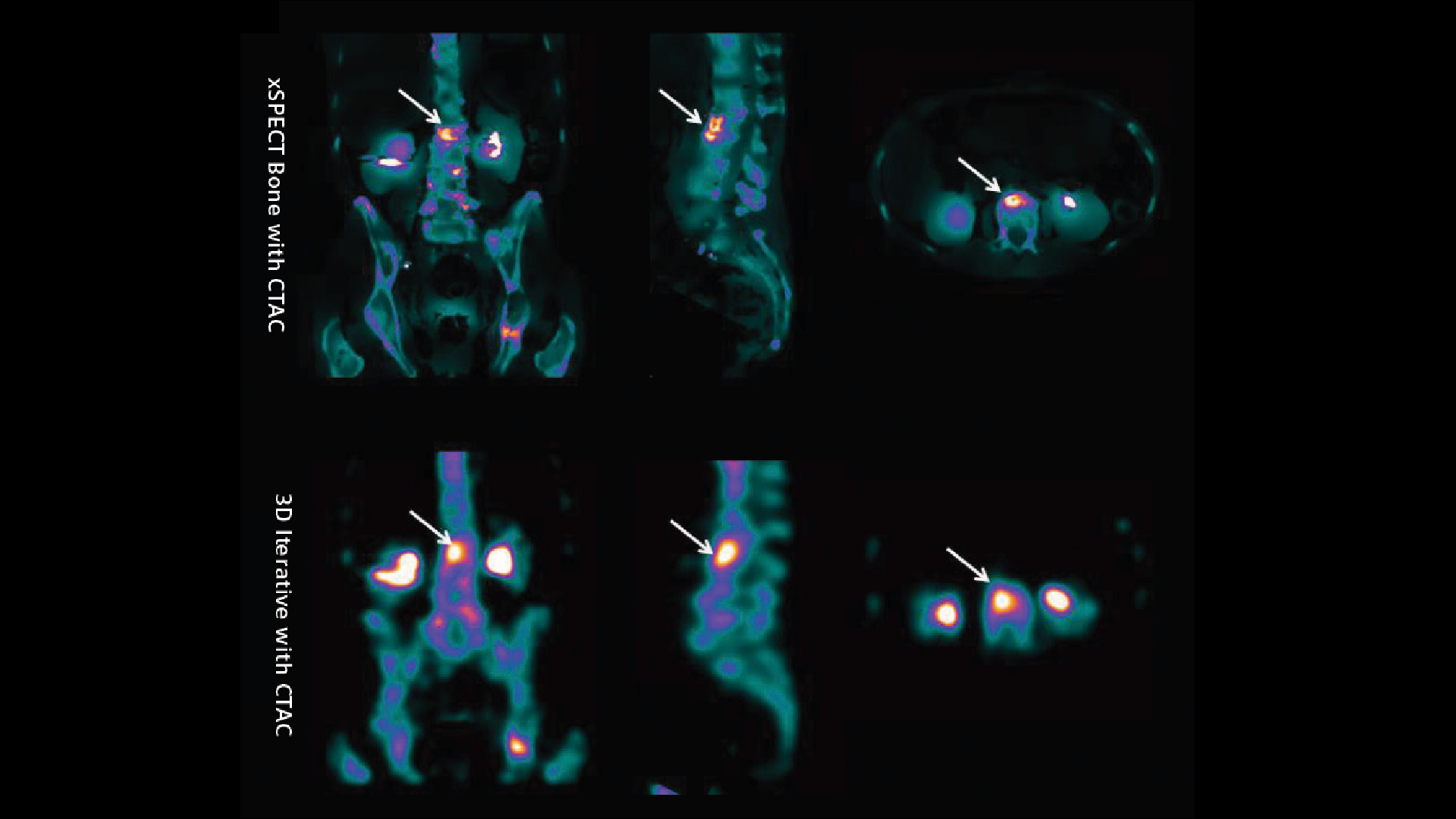 Partial vertebral compression defined by xSPECT Bone - Siemens Healthineers