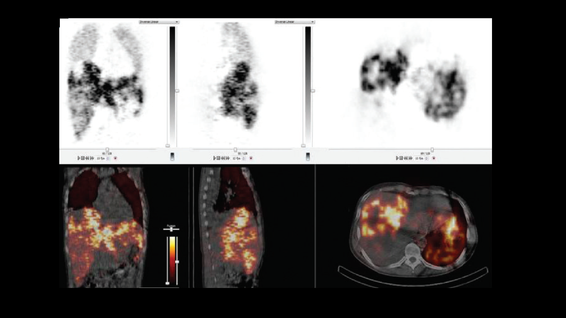 Quantitative SPECT imaging of hepato-pulmonary shunting prior to SIR ...