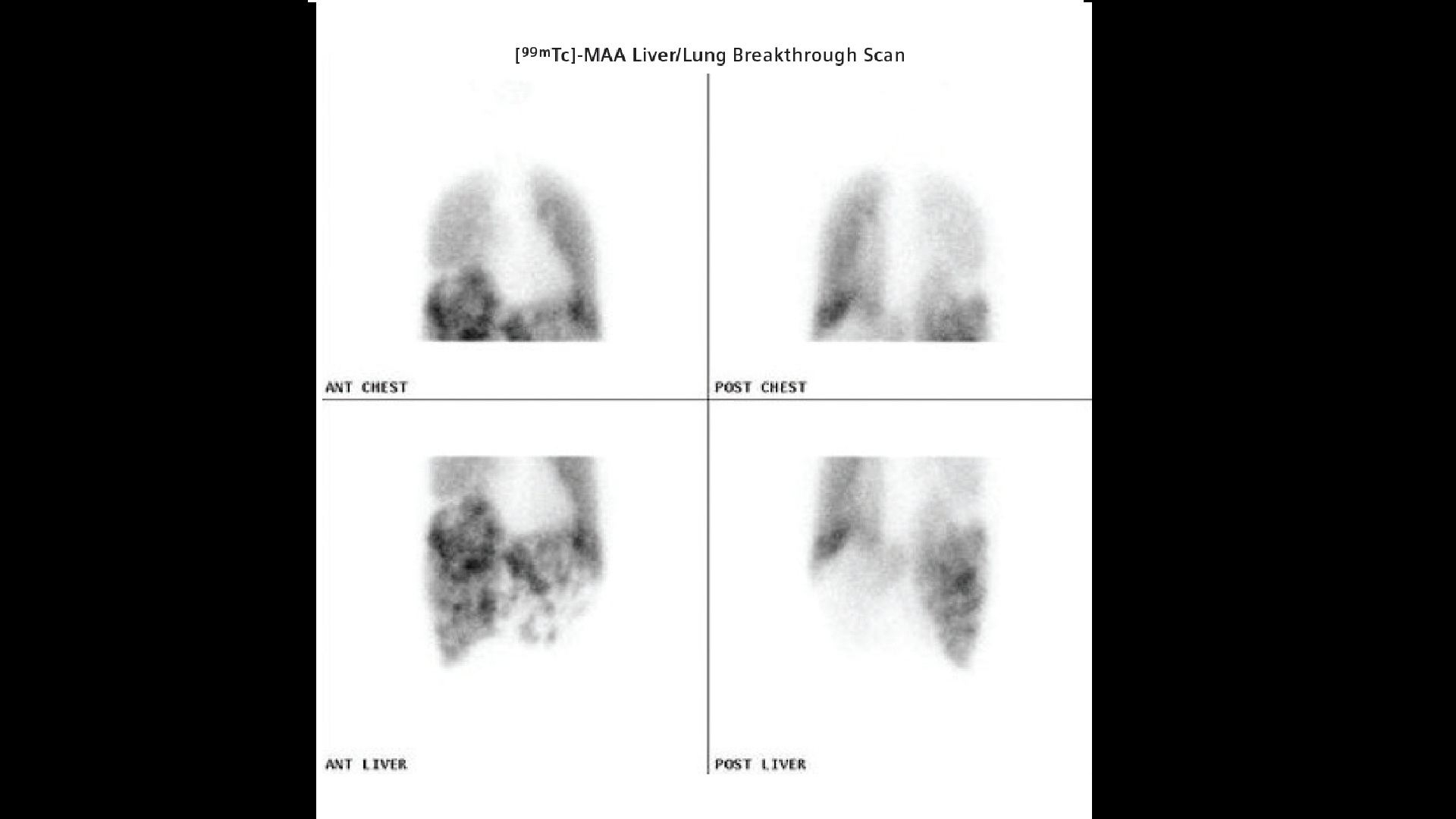 Quantitative SPECT imaging of hepato-pulmonary shunting prior to SIR ...