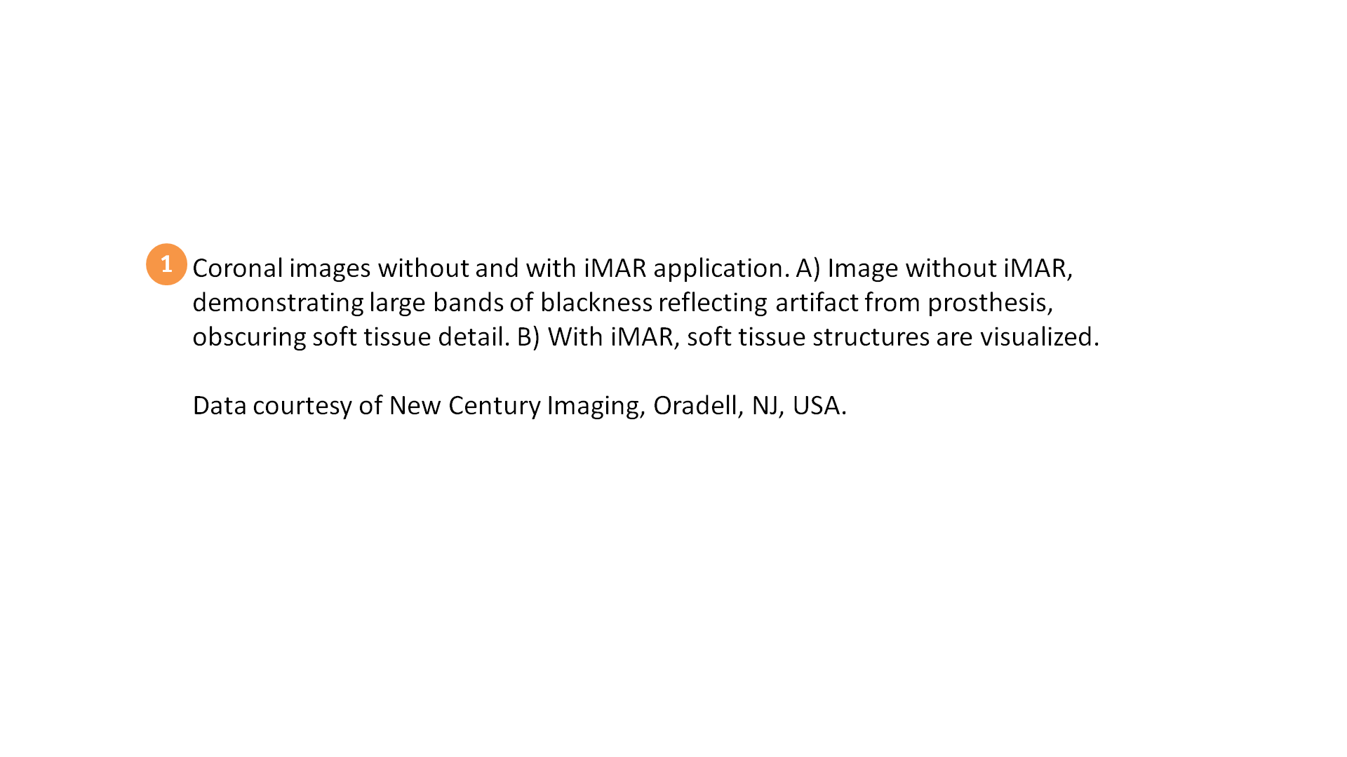 Prosthetic metallic artifact reduction - Siemens Healthineers USA