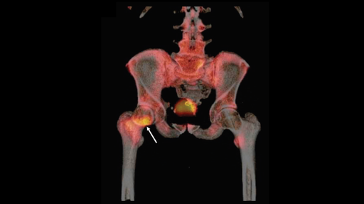 Delineation of femoral marrow infiltration in a patient of lymphoma ...