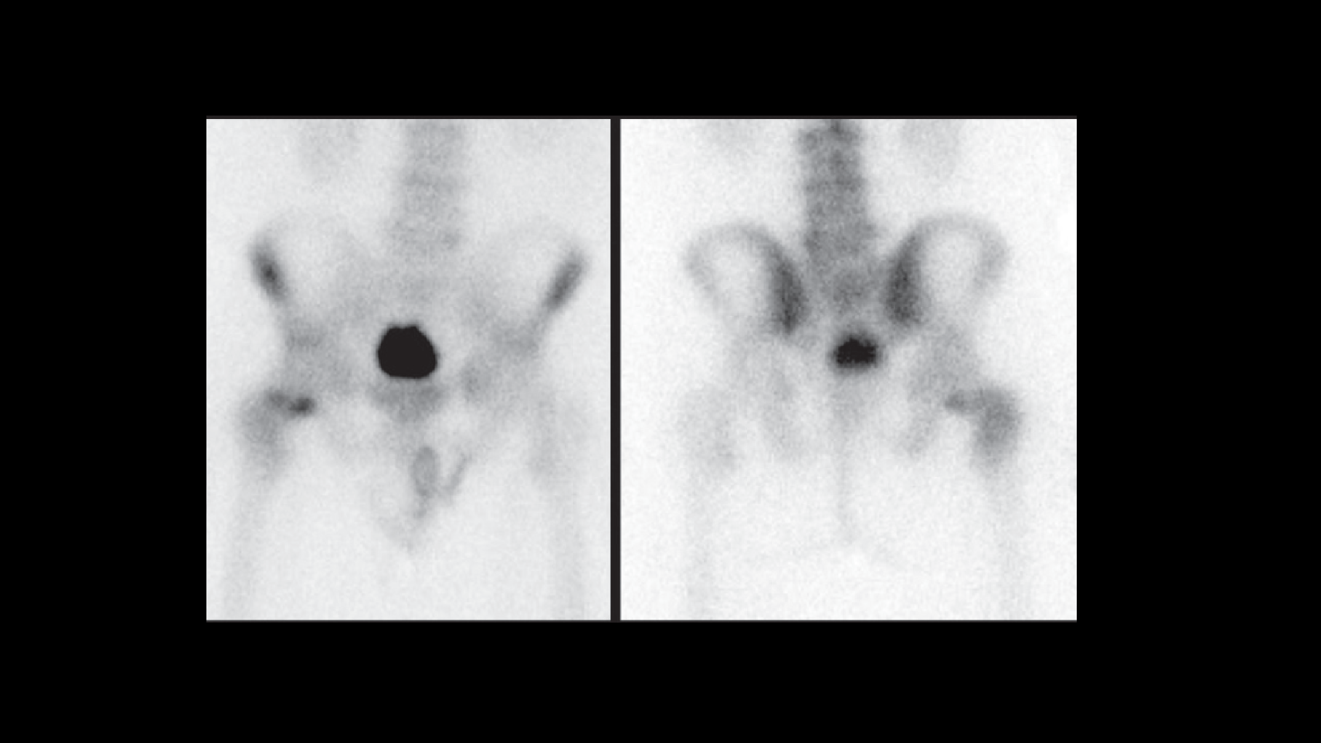Delineation of femoral marrow infiltration in a patient of lymphoma ...