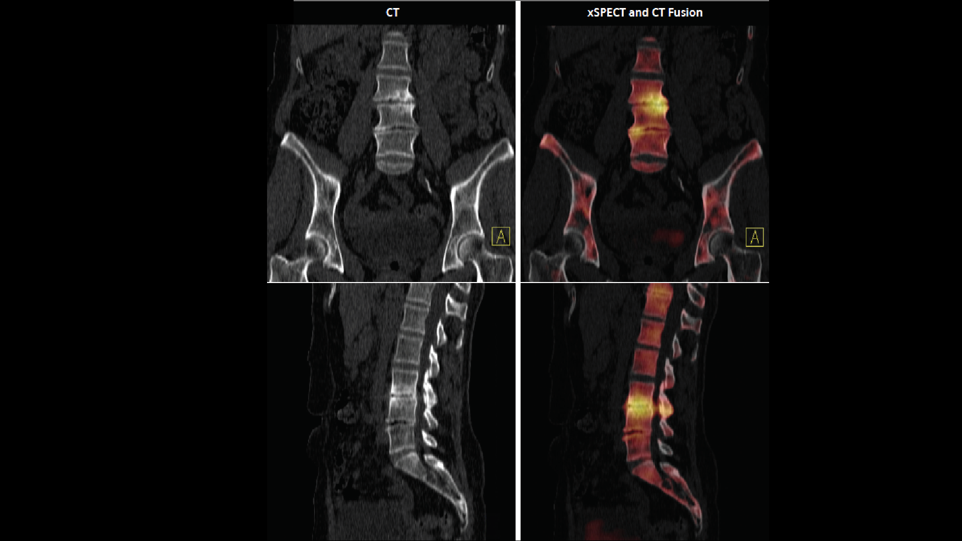 Delineation of intervertebral disc space infection - Siemens ...