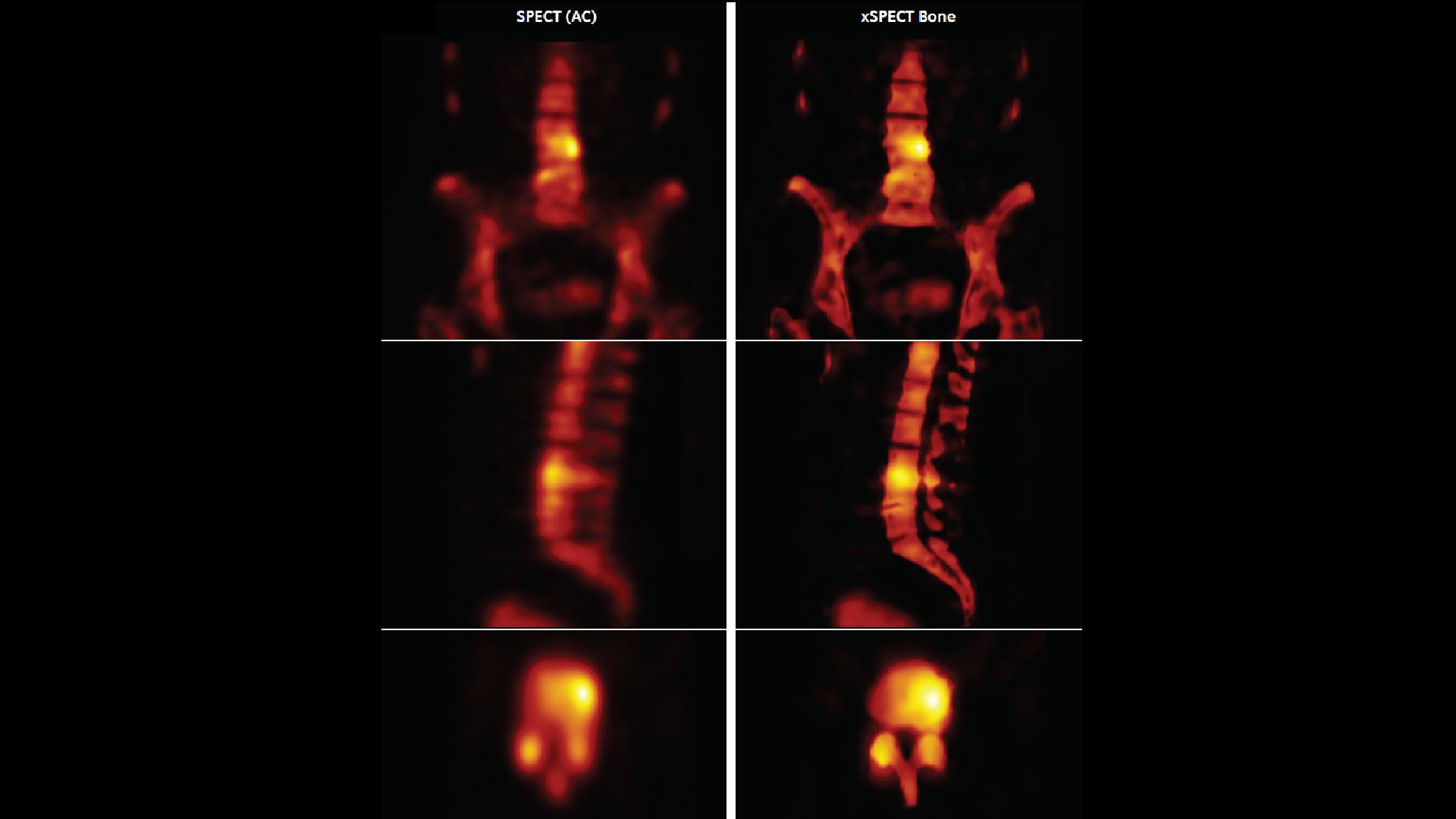 Delineation of intervertebral disc space infection - Siemens ...