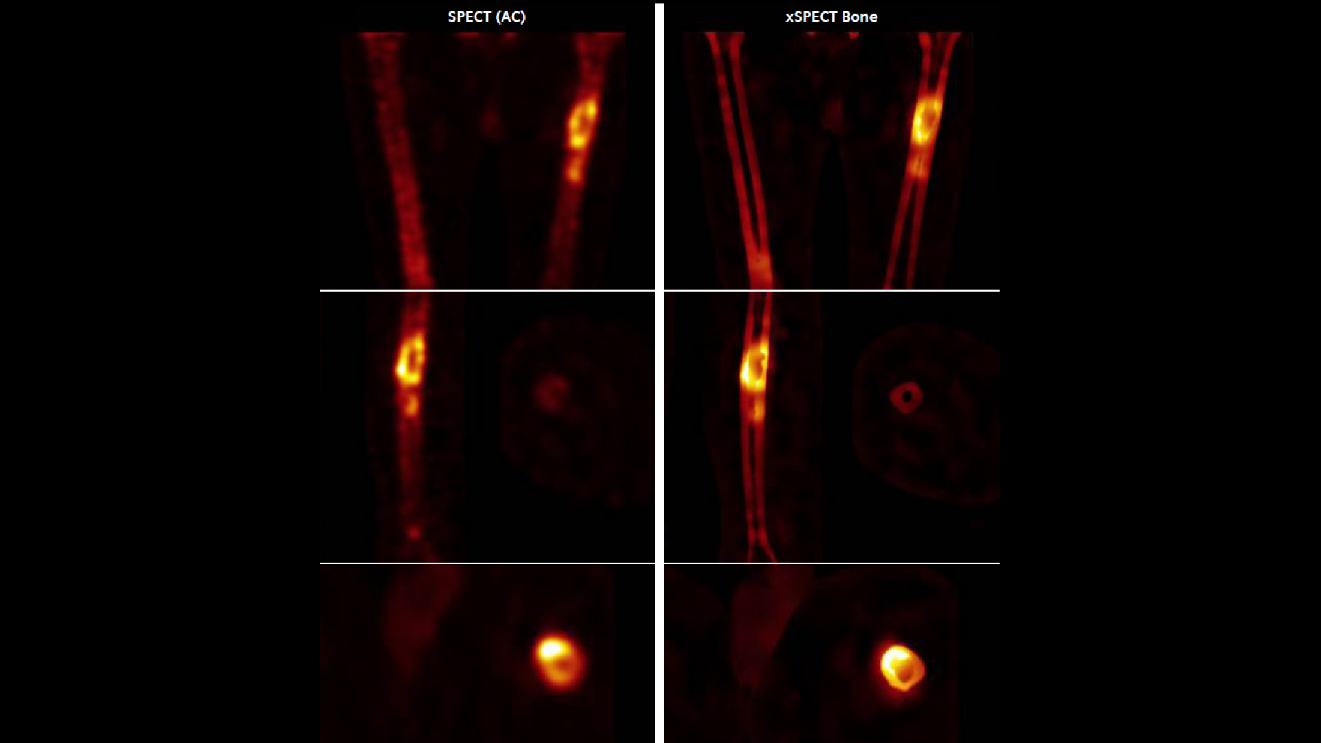 Delineation of intervertebral disc space infection - Siemens ...