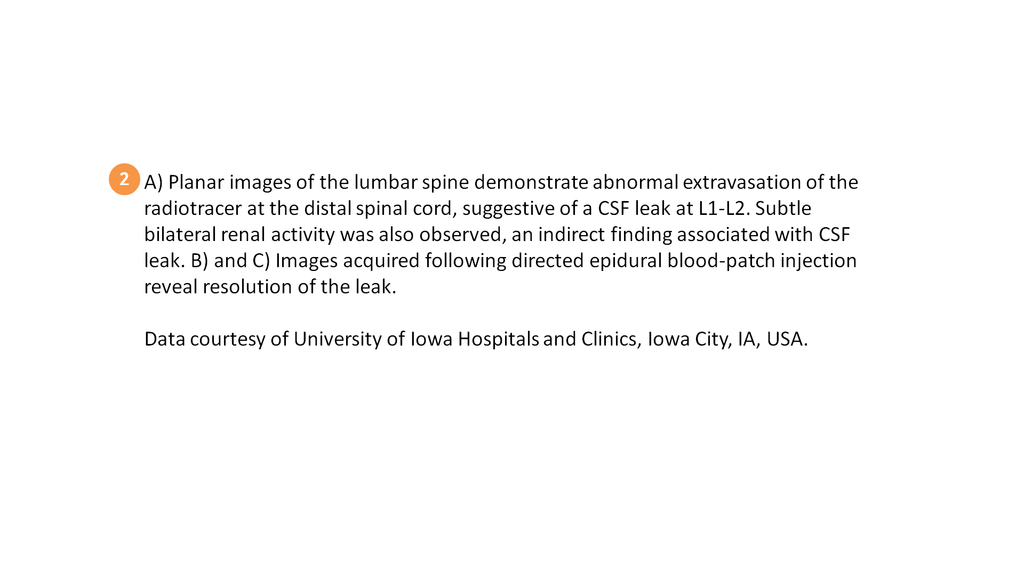 Nuclear cisternography in the detection of CSF leak - Siemens ...