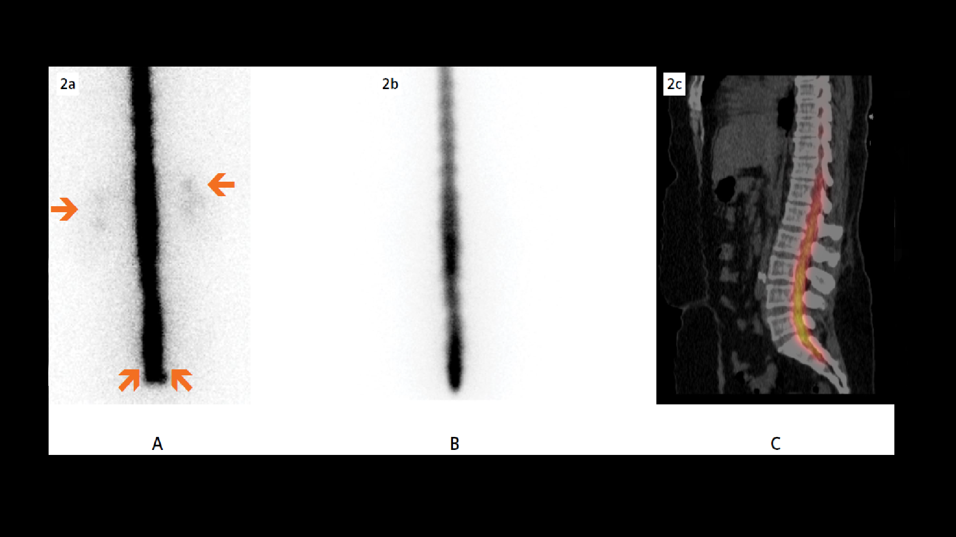Nuclear Cisternography In The Detection Of Csf Leak Siemens Healthineers