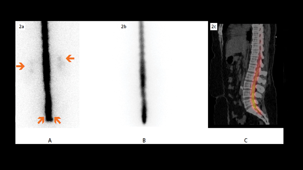 Nuclear cisternography in the detection of CSF leak - Siemens ...
