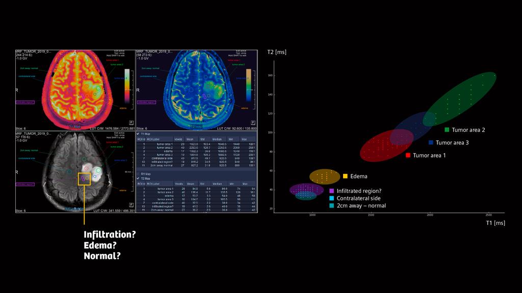 MR Neuro Imaging - MRI Neurology - Siemens Healthineers