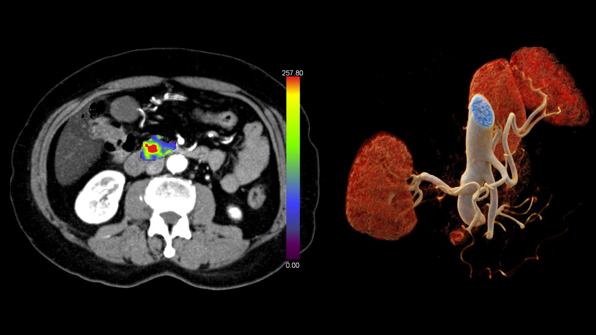 CT Imaging of Insulinomas – Biphasic or Dynamic? - Siemens Healthineers USA