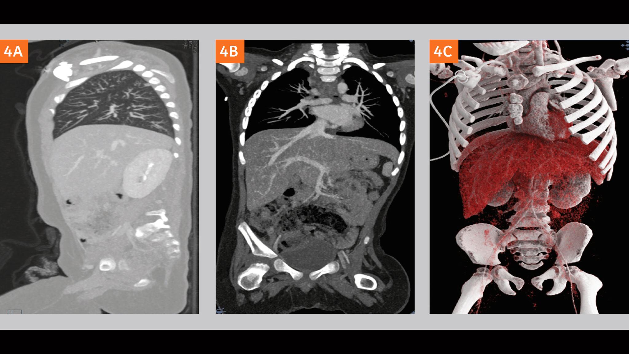 New Trends in Pediatric CT Imaging
