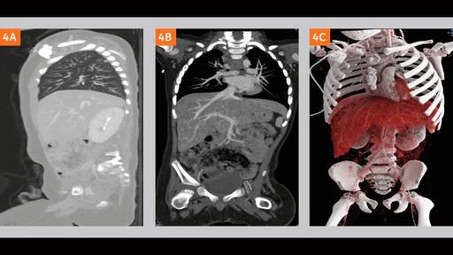 New Trends in Pediatric CT Imaging