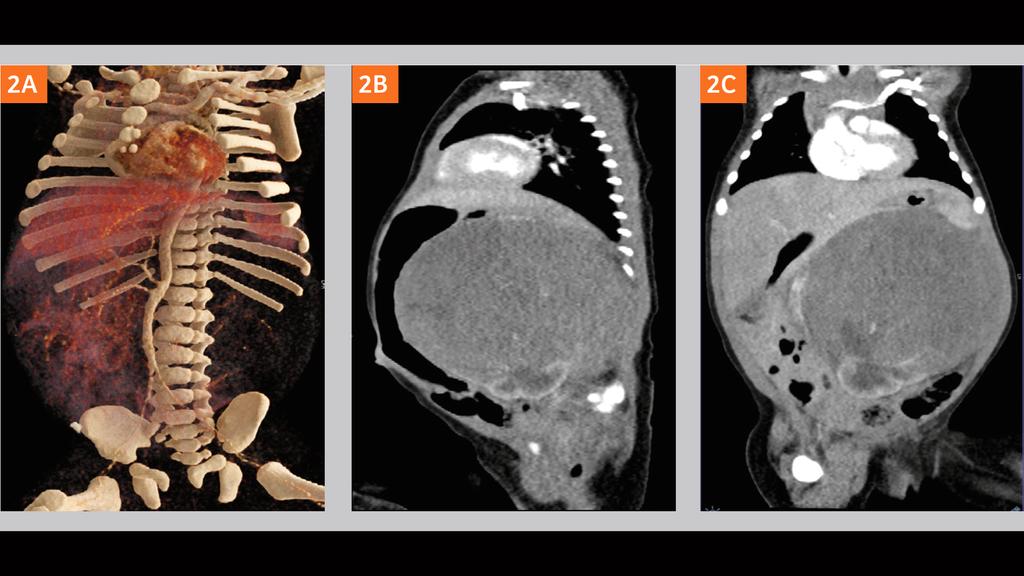 New Trends in Pediatric CT Imaging