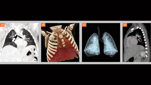 New Trends in Pediatric CT Imaging