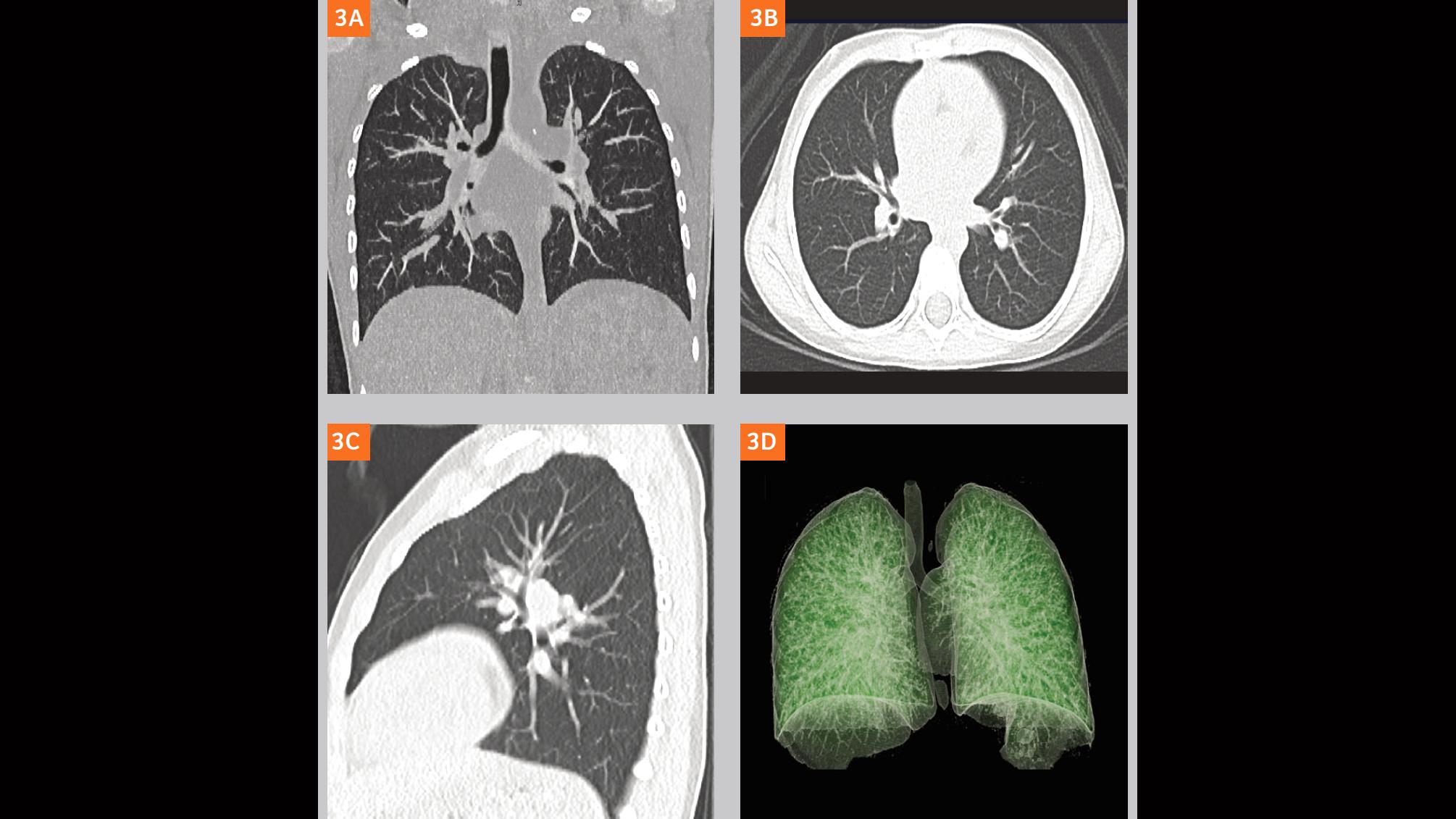 New Trends in Pediatric CT Imaging