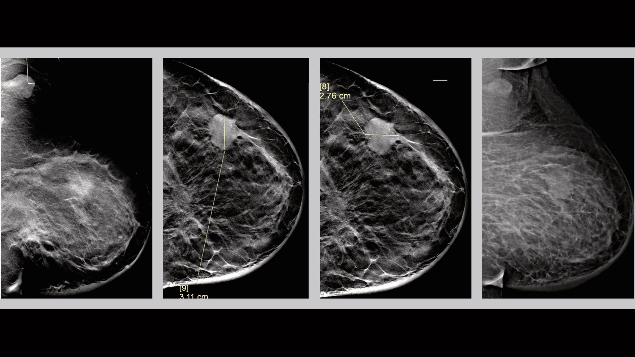 50° wide-angle HD Breast Tomosynthesis Mammography on MAMMOMAT Revelation