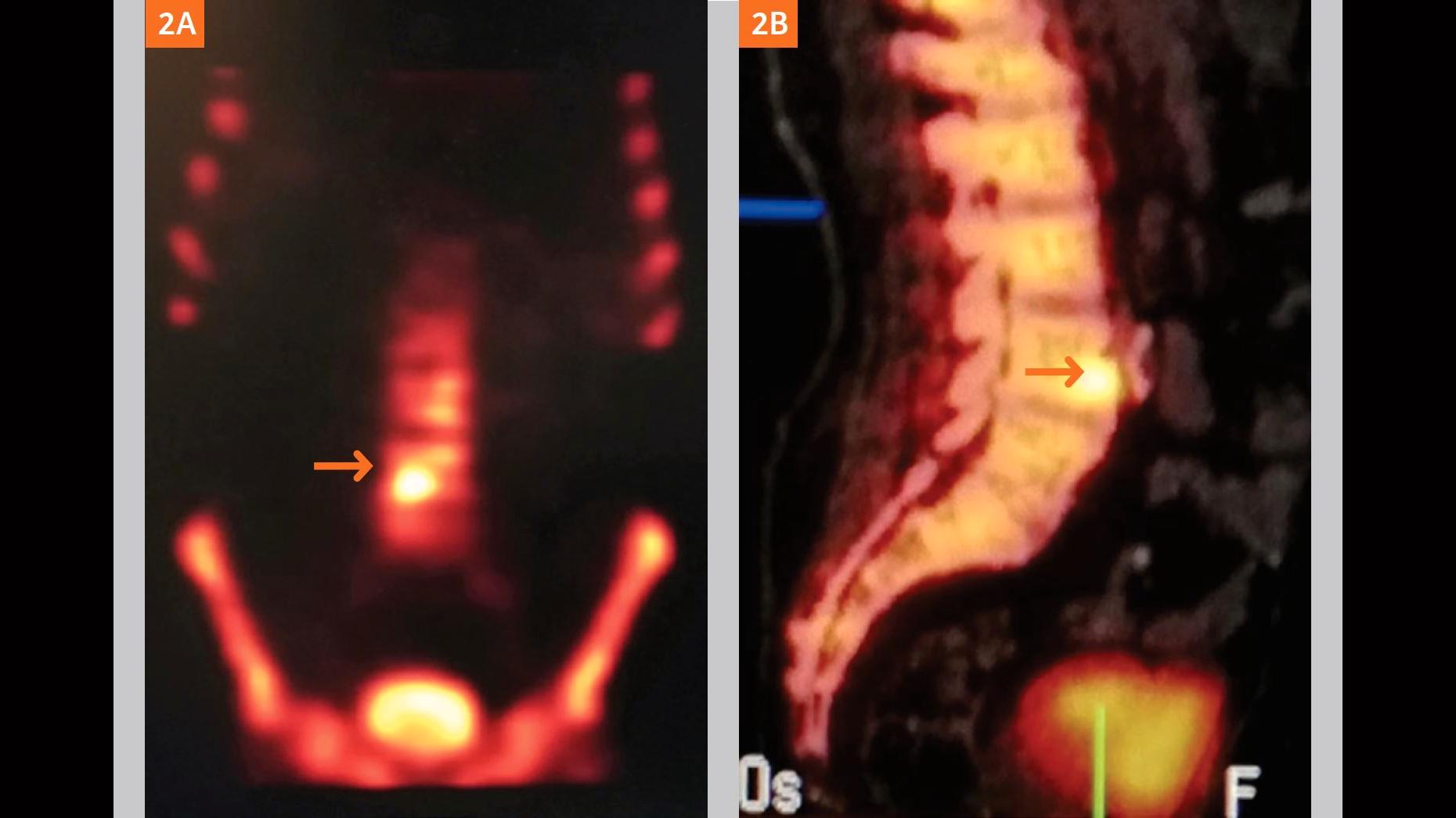 Bone scintigraphy imaging; The impact of adding SPECT-CT facility